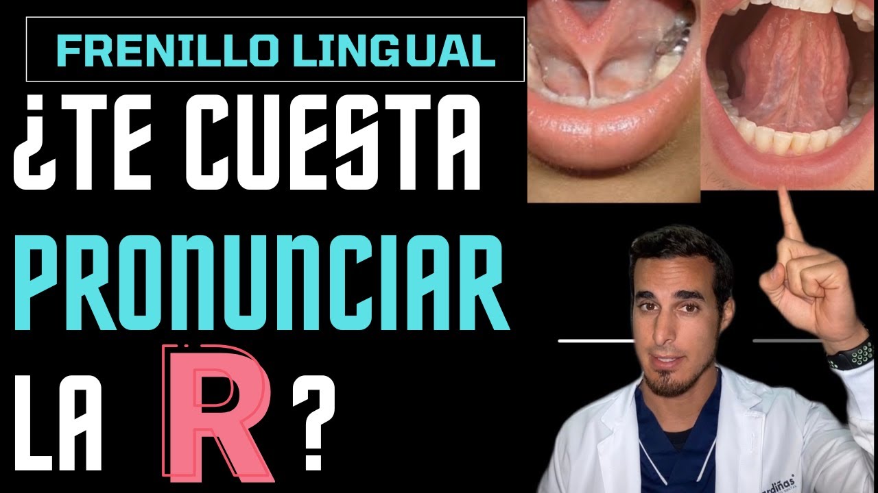 Frenillo de la lengua en adultos riesgos, beneficios y necesidad - Tras ...